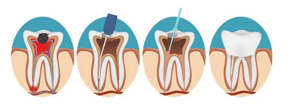 Rotfyllning - Dental Home